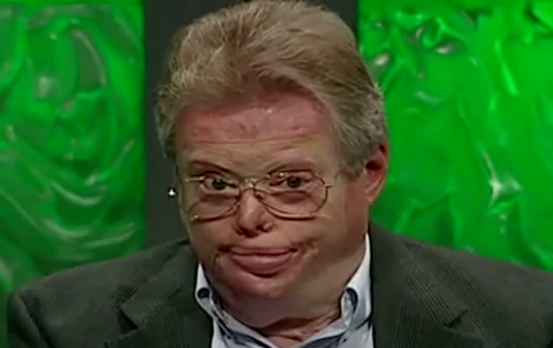 Two-Time Burn Victim W. Mitchell Will Teach You How To Overcome Any ...